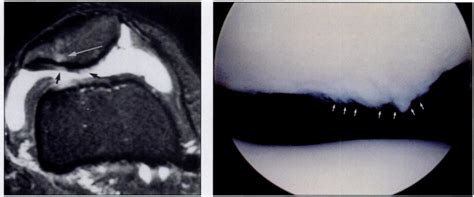 39 Year Old Woman With Grade 2 Patellar Chondral Lesion A Axial Download Scientific Diagram