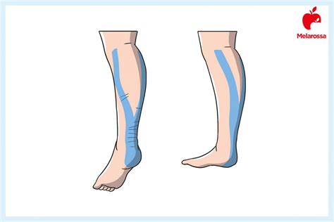 Kinesio Taping Che Cosè A Cosa Serve Come Si Usa Benefici