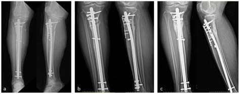 Tibial Insufficiency Fracture With Characteristics Of An Atypical