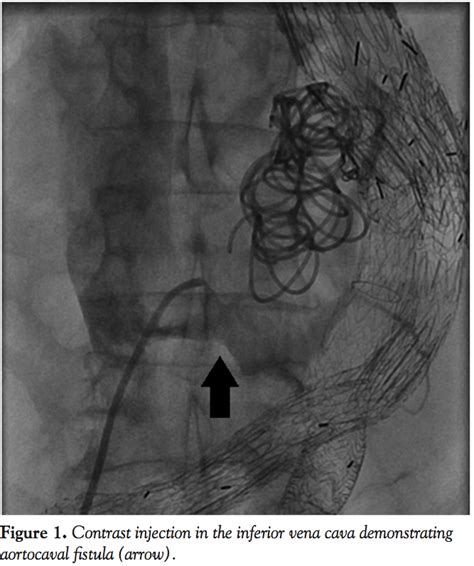 Percutaneous Closure Of Aortocaval Fistula Using The Amplatzer Muscular
