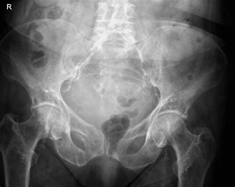 CT Case 097 LITFL CT Scan Interpretation