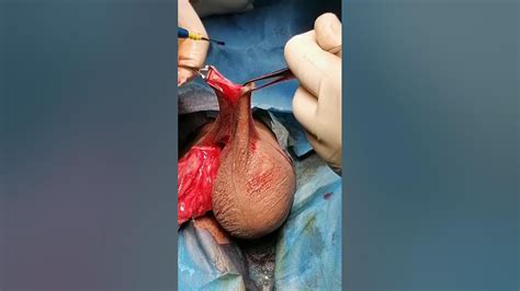 Bilateral Testicular Hydrocelectomy Drtalib H Al Shawoush
