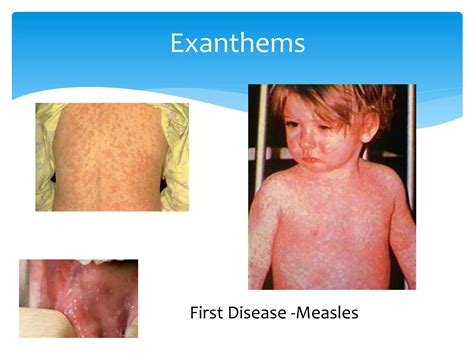 Paediatric Rashes Pptx