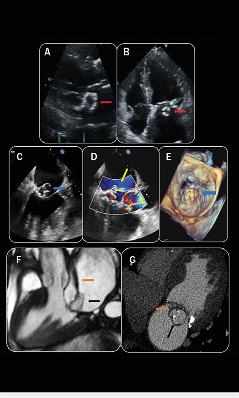 Figure 1 From Perforated Aneurysm Of The Posterior Mitral Valve Leaflet
