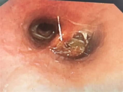 58 Year Old Man Inhales Cockroach In Sleep Causing Respiratory Issues