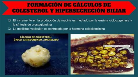 Fisiopatologia Coledocolitiasis Y Colecistitis Pptx