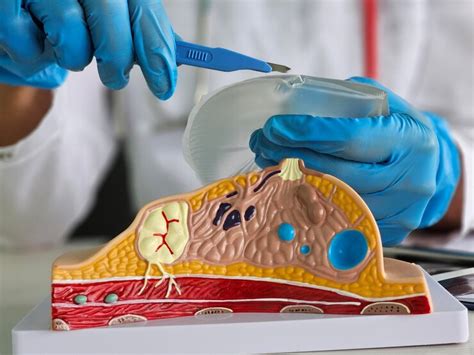 Doctor And Rupture Of Breast Silicone Implant Using Anatomical Model