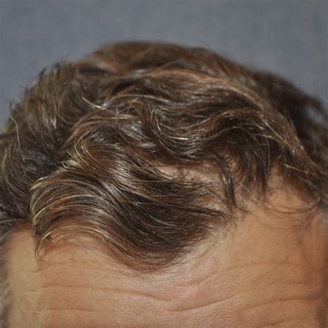 Norwood Scale Causes Stages And Treatments Wimpole Clinic