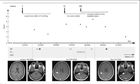 Figure 1 From Severe Relapse Of Multiple Sclerosis During Plasma