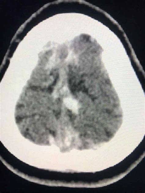 Hyperdense Venous Sinusloss Of Grey White Diff In Right Frontal Head
