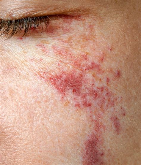 Birthmarks And Removal Mesa Az Sagebrush Dermatology
