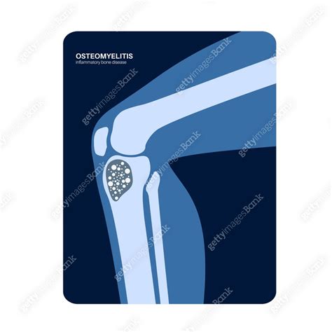 Tibia Bone Osteomyelitis 이미지 1703713116 일러스트 무료 일러스트 게티이미지뱅크