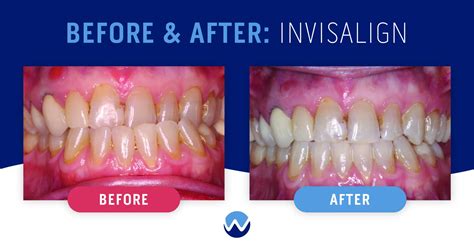 Crooked Teeth Before And After Invisalign