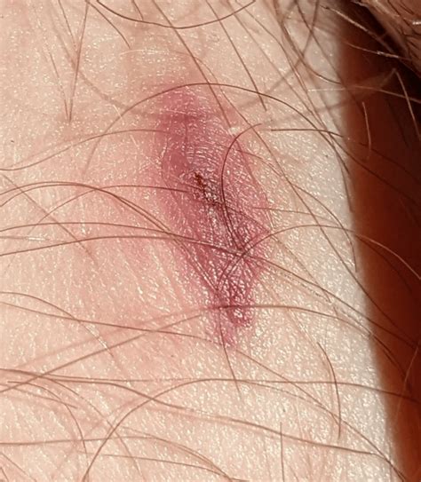 Bleeding Lesion In Groin Not Aware Of Mole No Cyst Or Pimple Flat To