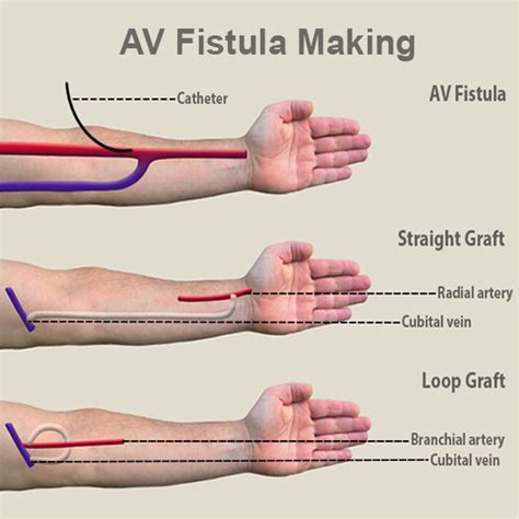 Av Fistula Making Ds Dialysis Center