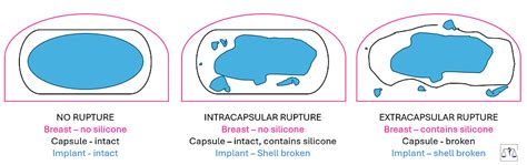 Breast Implant Rupture Should I Be Worried