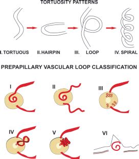 Prepapillary Vascular Loop A New Classification Eye
