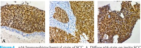 Figure 1 From P16 Expression In Uterine Cervical Lesions And Its Role