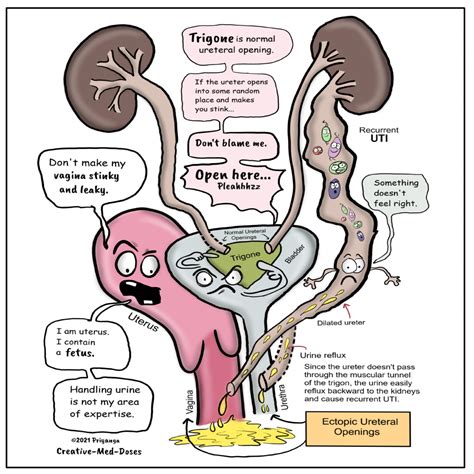 Prolapsed Ureterocele
