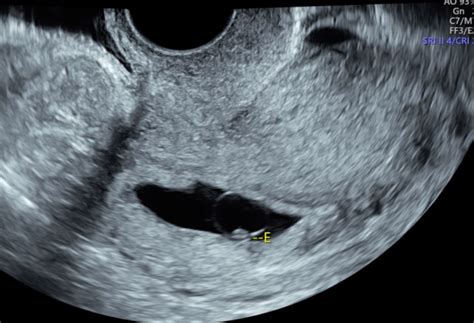 Expanded Amnion Sign Dr Ankit Singh