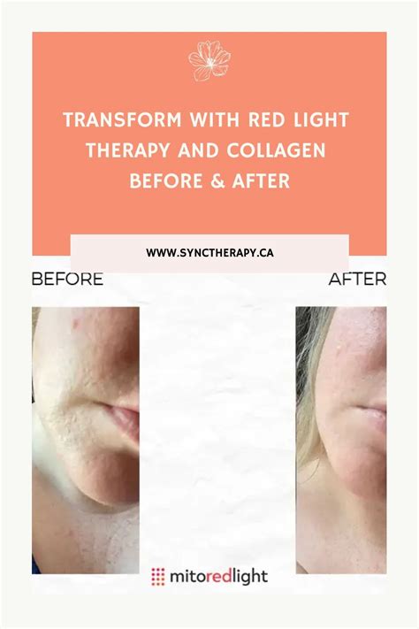 Amazing Red Light Therapy Before And After Photos Wrinkles Psoriasis