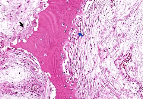 Pathology Outlines Avascular Necrosis