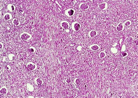 Diffuse Proliferative Glomerulonephritis 1 Greeting Card By Nigel Downer Science Photo Library