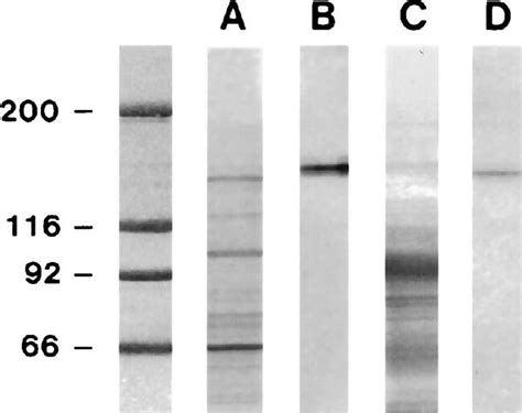 Angiosarcomas Express Mixed Endothelial Phenotypes Of Blood And