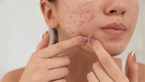 Угри акне причины и лечение угревой сыпи женщин и мужчин