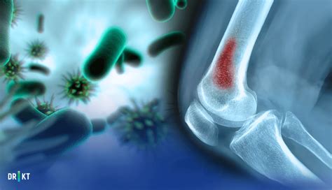 Osteomyelit Nedir Kemik İltihabı Belirtileri Ve Tedavisi Kayhan Turan Robotik Ortopedi