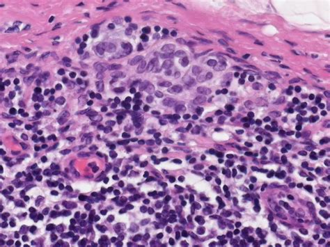 Melanoma Sentinel Lymph Node Biopsy