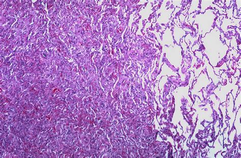 Atelectasis Collapsed Lung Tissue To The Left With Slit Li Flickr
