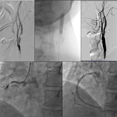 Illustrated Case Of A Critical Event We Performed Carotid Artery