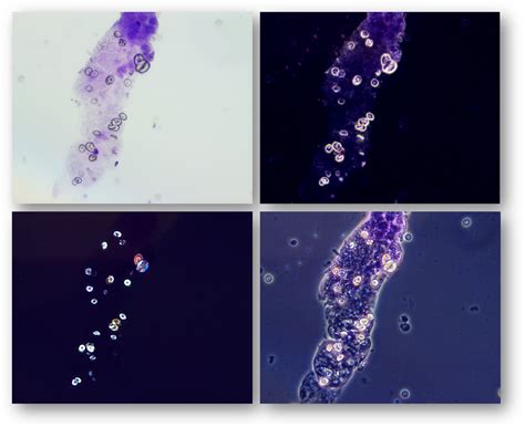 Urine Sediment Of The Month Waxy Casts Renal Fellow Network Urine