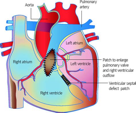 Congenital Heart Disease In Adults The Bmj