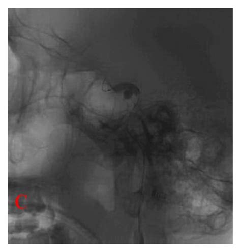 A 39 Year Old Male Suffered From A Right Ccf After A History Of Head