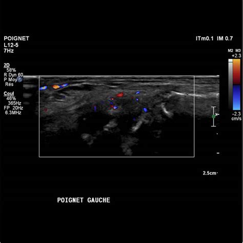 Doppler Ultrasound Examination Of A Second Mcp Presence Of Synovitis