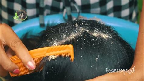 She Scratch Dandruff Look So Interested 2312 Youtube
