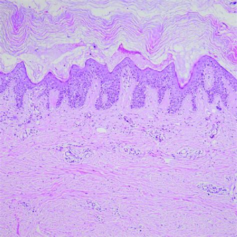 Lamellar Hyperkeratosis Papillomatosis Basal Hyperpigmentation In The