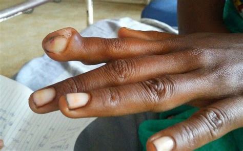 Tuberculous Dactylitis Medizzy