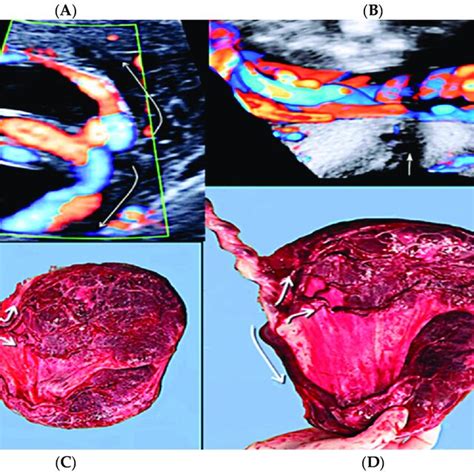 Pregnancy At 21 Weeks Gestation Succenturiate Placenta And Placenta