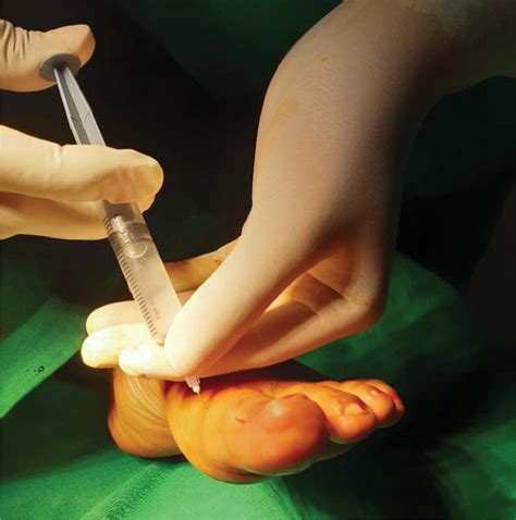 Subcutaneous Infiltration Of 2 Lidocaine At Base Of Disease Great Toe