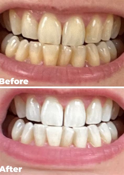 These 95p Teeth Whitening Strips Have Given Me Back My Confidence