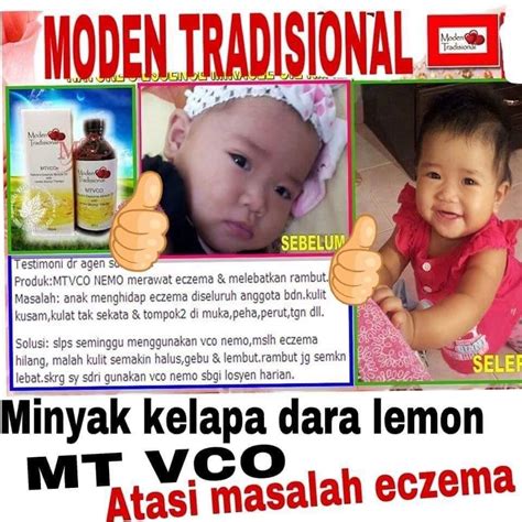Nemo Oil Vco Thyroid Dandruff And Itchy Hairfalleczemapsoriasis