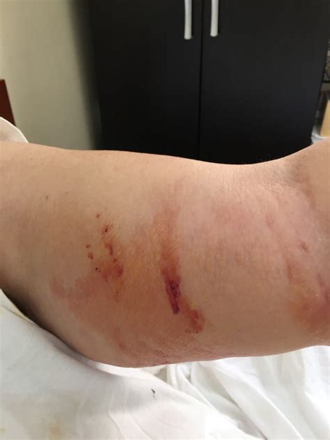 Cellulitis After Mastectomy When To Suspect Rojoson Medical Clinic