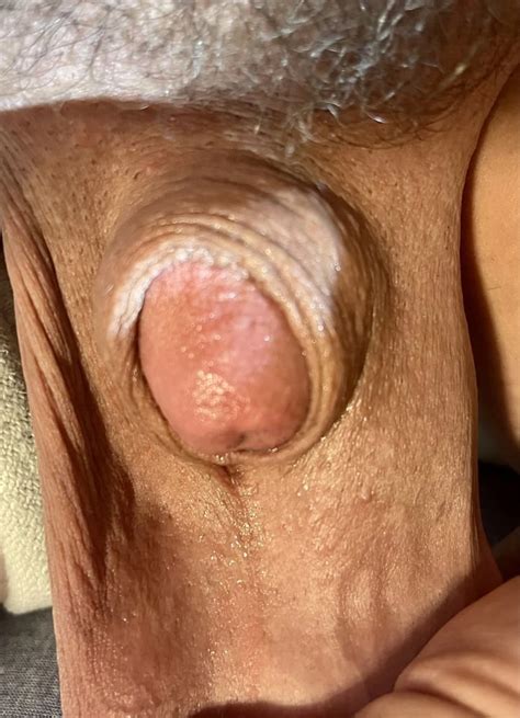 Tiny We We Micro Cock 8 Nude Pics Xhamster