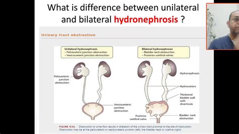 What Is The Difference Between Unilateral And Bilateral Hydronephrosis Puv Bladder Neck