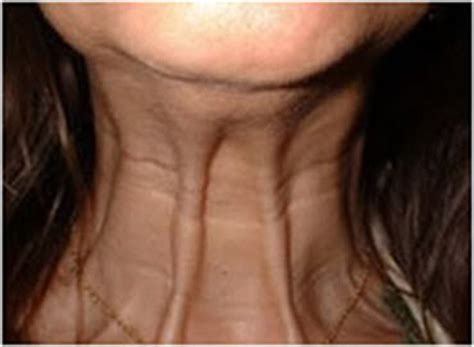 Platysmal Bands Dr Brads Clinic