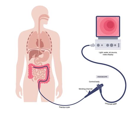 Colonoscopy Procedure In Singapore Dr Ronnie Mathew Crcs