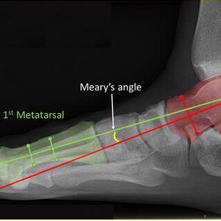 Mearys Angle The Angle Between The Longitudinal Mid Talar Axis And